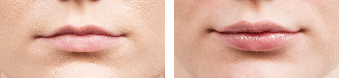 Lip augmentation treatment | Lip enhancement London - Milo Clinic