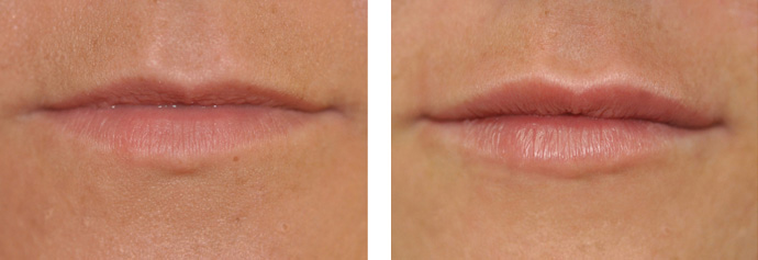 Lip augmentation treatment | Lip enhancement London - Milo Clinic