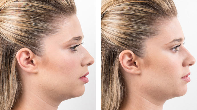 Harley street Non-Surgical Nose Job | Nose fillers - Milo Clinic